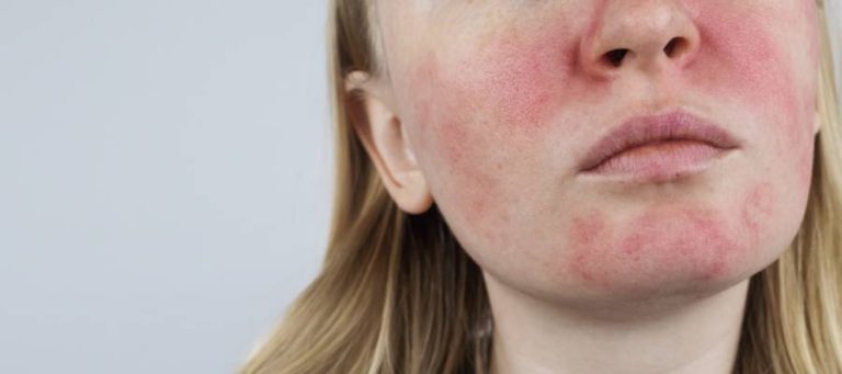 Gül Hastalığı Tetikleyicileri: Uzak Durmanız Gereken 10 Yiyecek ve ...